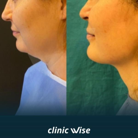 Chin Aesthetic Turkey - Clinic Wise