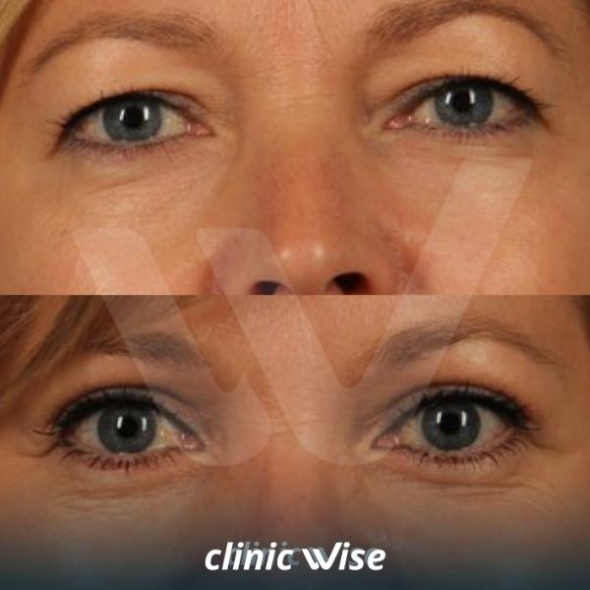 Eyelid Surgery Turkey - Clinic Wise