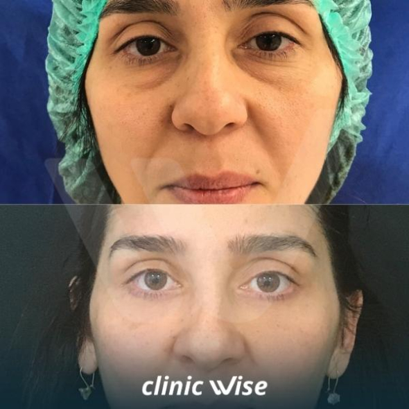 Eyelid Surgery Turkey - Clinic Wise