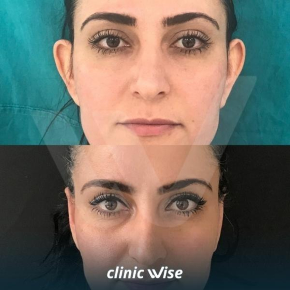 Otoplasty Turkey - Clinic Wise